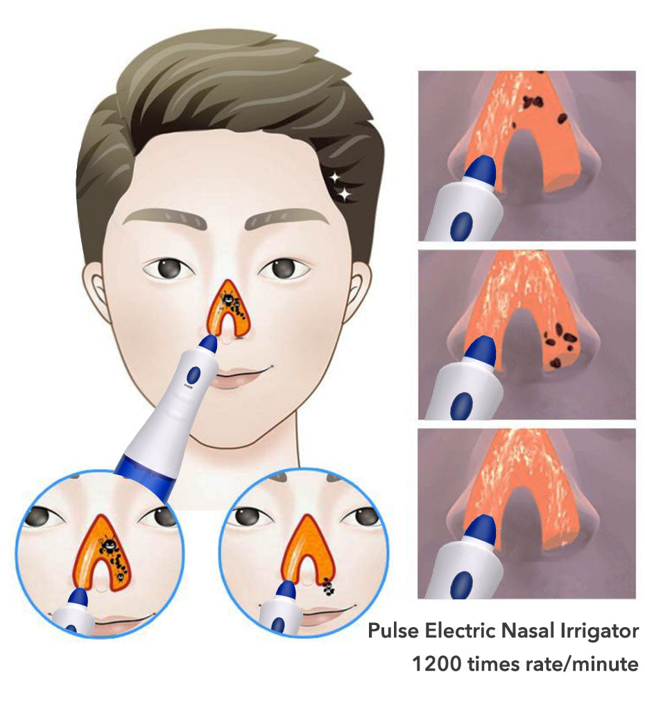 Electric Nasal Irrigator Nose Cleaning Machine Nasal Wash Cleaner Prev ...